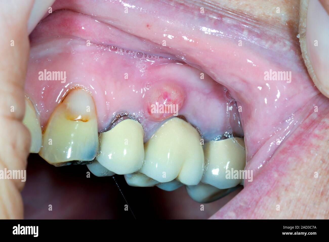 Zahnmedizinische Sinus. Nahaufnahme einer intraoralen für ...
