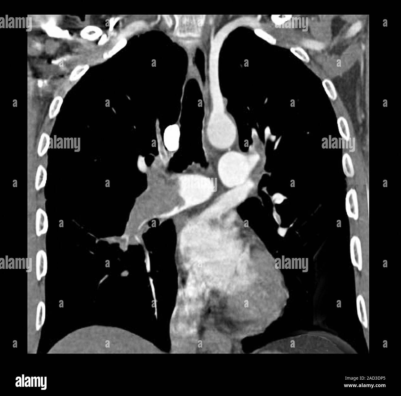 Lungenembolie. Farbige frontal Computertomographie (CT)-Scan eines axialen Schnitt durch die ...