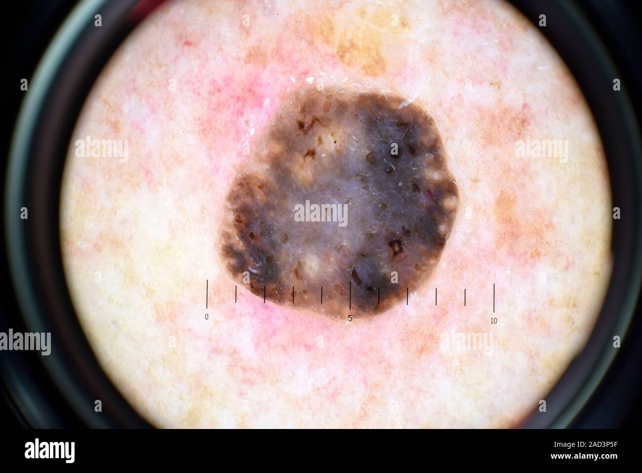 Seborrhoische Keratose. Dermatoskop Bild eines seborrhoische Keratose ...