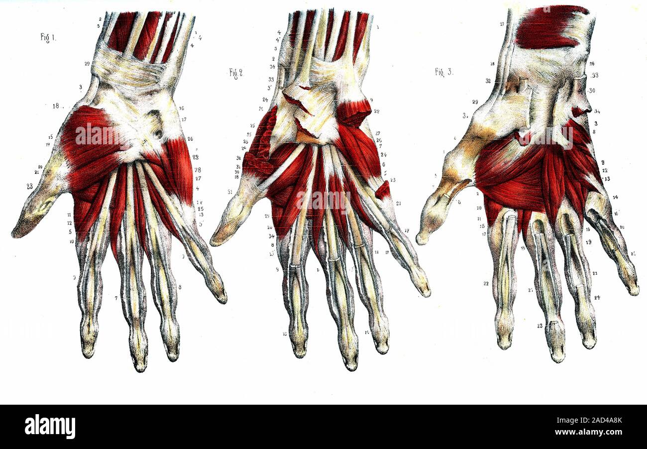 Die menschliche Hand. 1866 anatomische Abbildung: die Muskeln und ...