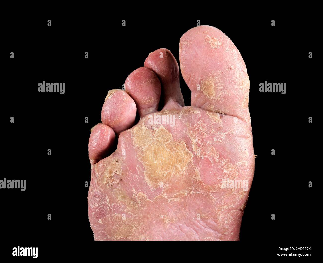 Psoriasis. Psoriasis, die den Fuß eines 70-jährigen männlichen ...