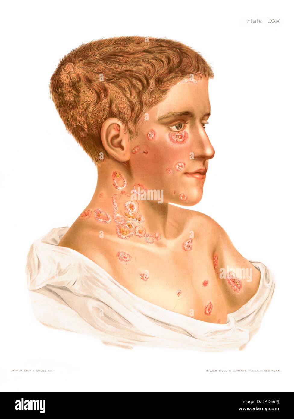 Ringworm. Historische medizinischen Abbildung eines jungen Leiden und ...