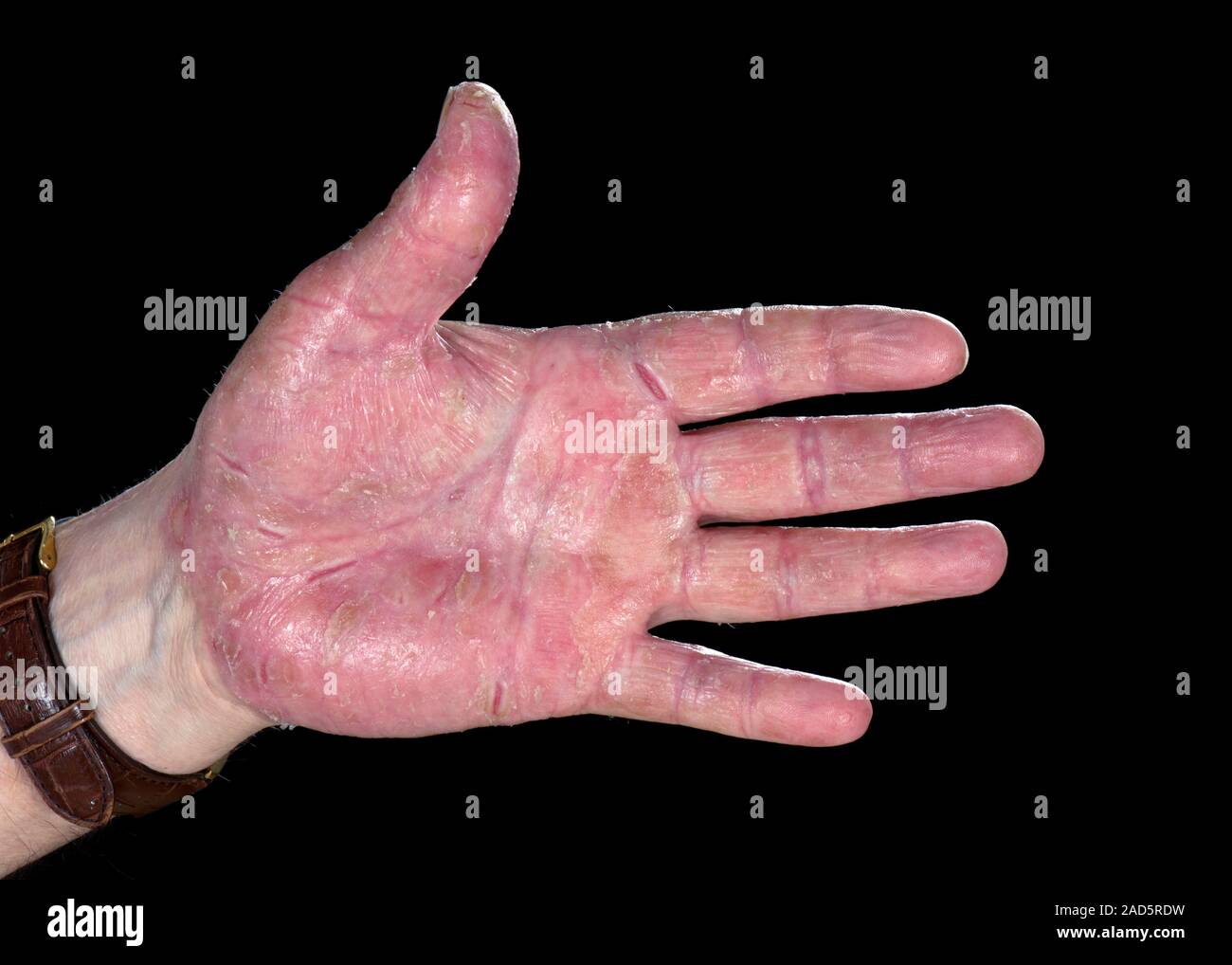 Psoriasis die Haut auf der Handfläche und den Fingern der Hand eines ...