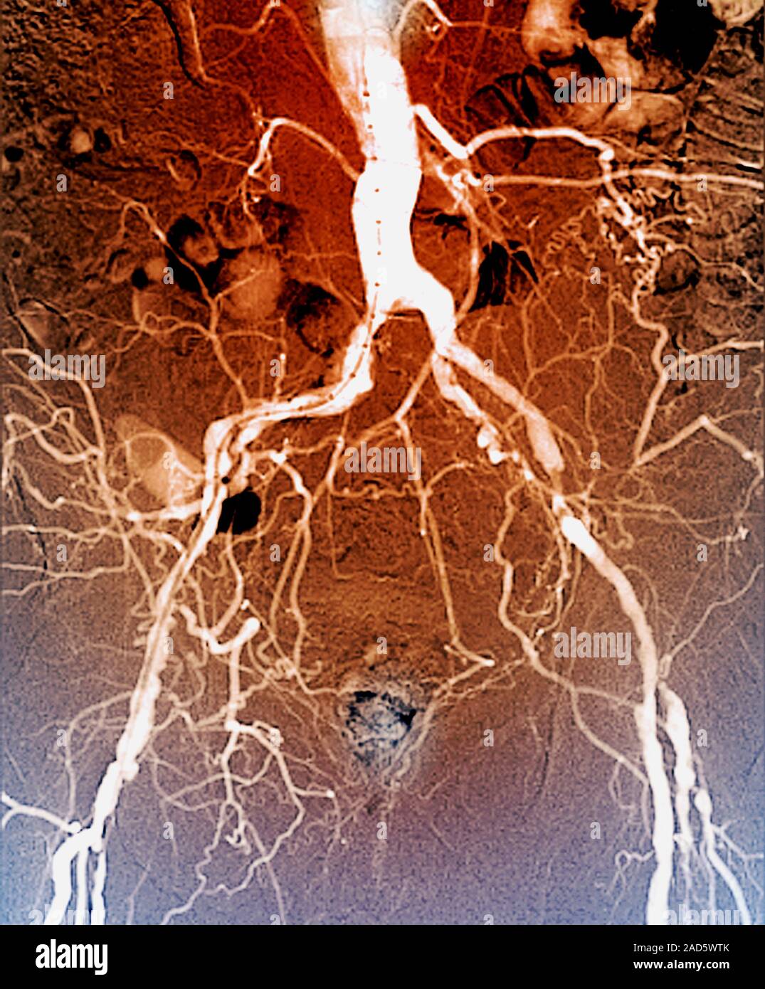 Iliaca verengten Arterie. Farbige Angiogramm (Blutgefäß X-ray) der ...