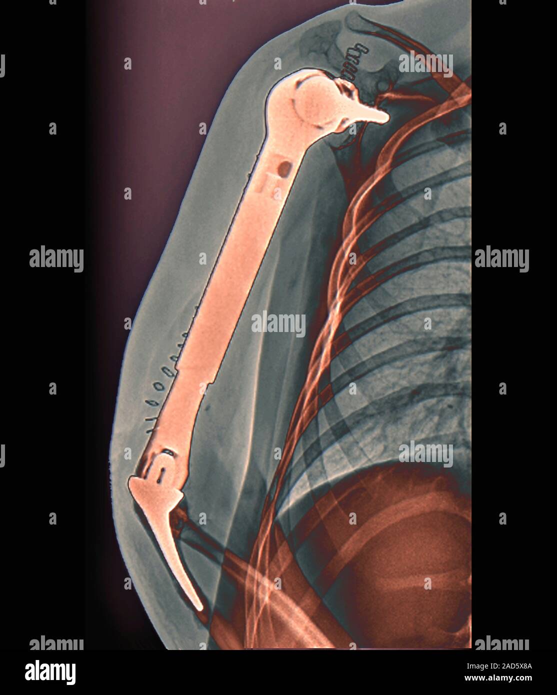 Prothetische Oberarm Knochen. Farbige X-ray der Oberarmknochen (Humerus ...