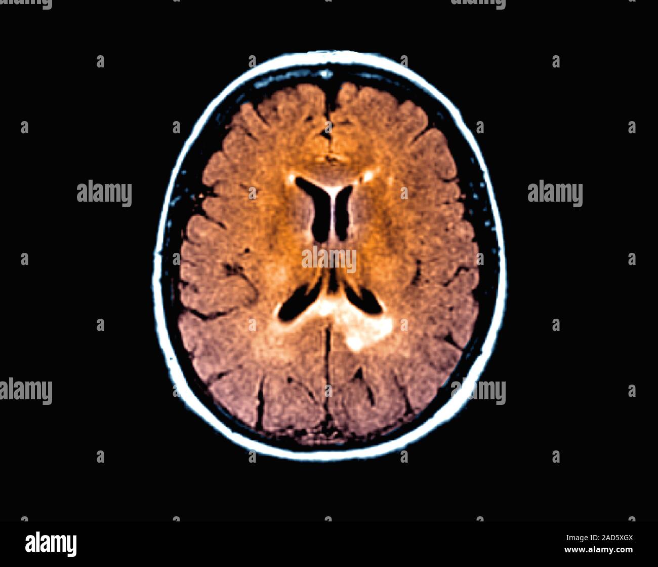 Multiple Sklerose. Farbige axiale Magnetresonanztomographie (MRT) des Gehirns eines 42-jährige ...