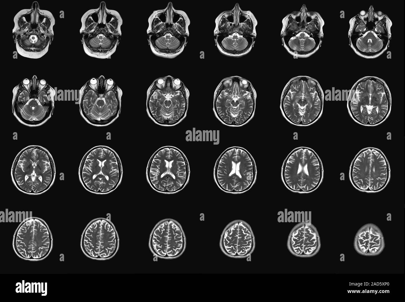 Die menschliche Anatomie des Gehirns. Serie von axialen Magnetresonanztomographie (MRT) Scans ...
