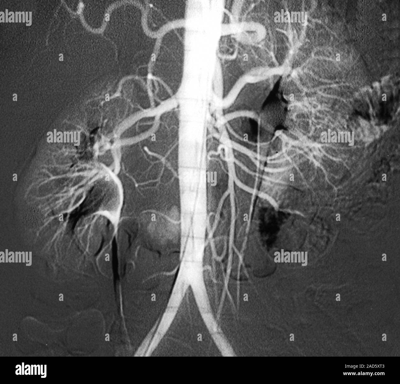 Niere Blutgefäße. Angiogramm (Blutgefäß X-ray) des normalen arterielle ...