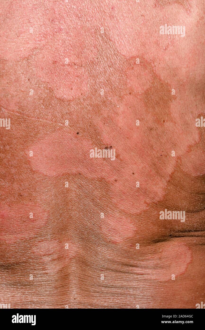 Ringworm Hautausschlag. Nahaufnahme einer Hautausschlag auf der ...