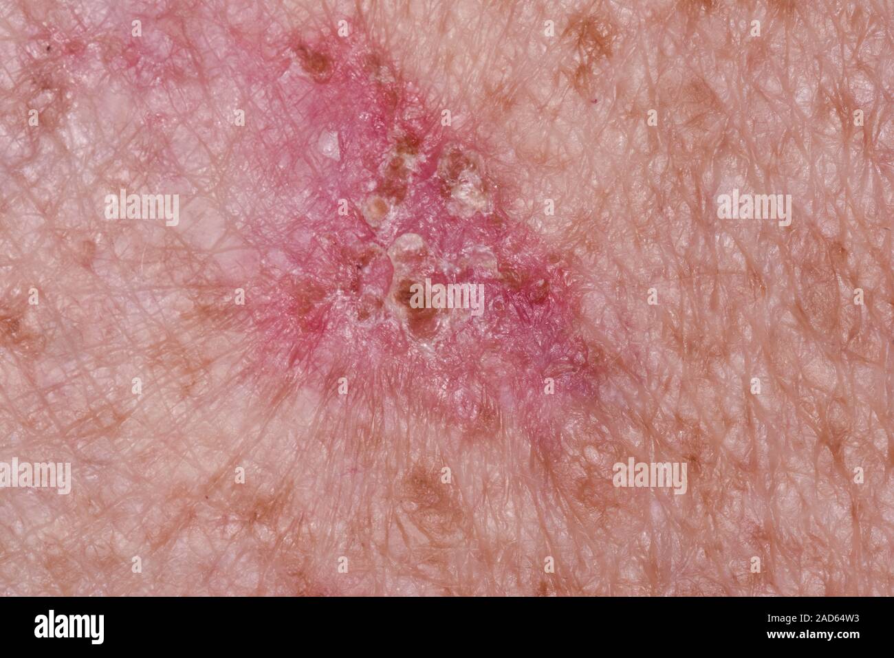 Basaliom Hautkrebs. Nahaufnahme einer Basalzellkarzinom (BCC) auf der ...
