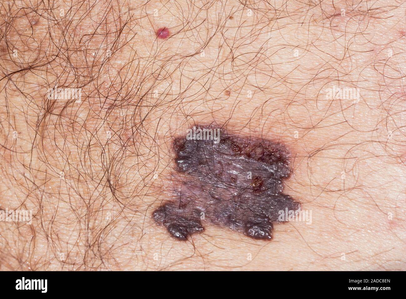 Malignes Melanom. Nahaufnahme eines malignen (bösartigen) Melanom auf ...