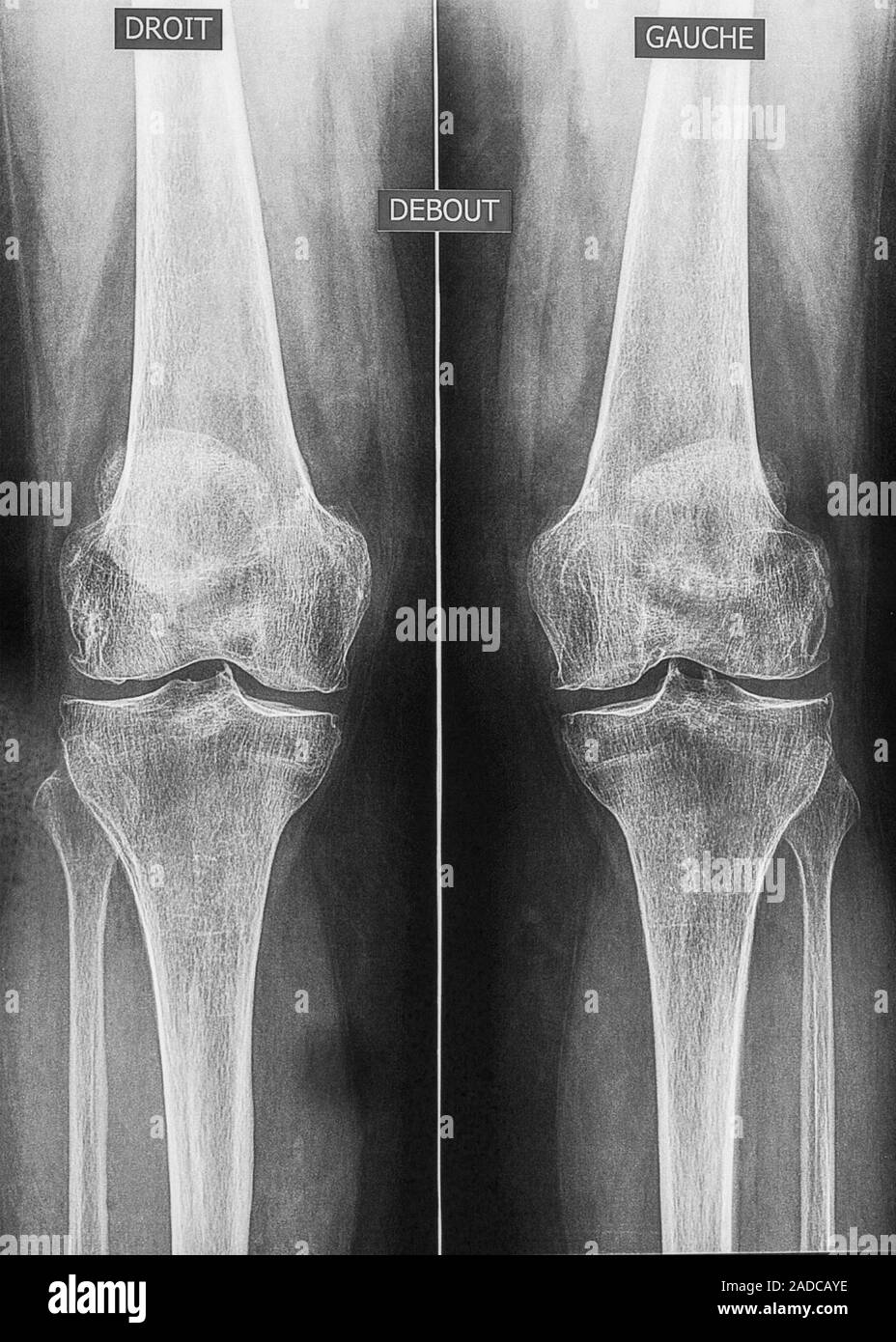 Frontale X-ray der Knie eines 72 Jahre alten weiblichen mit Arthrose im ...