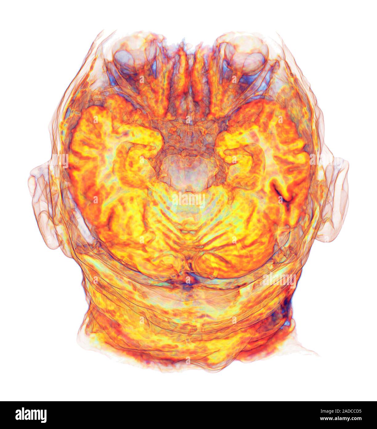 Menschlichen Kopf und Gehirn, farbige 3D-Magnetic Resonance Imaging ...