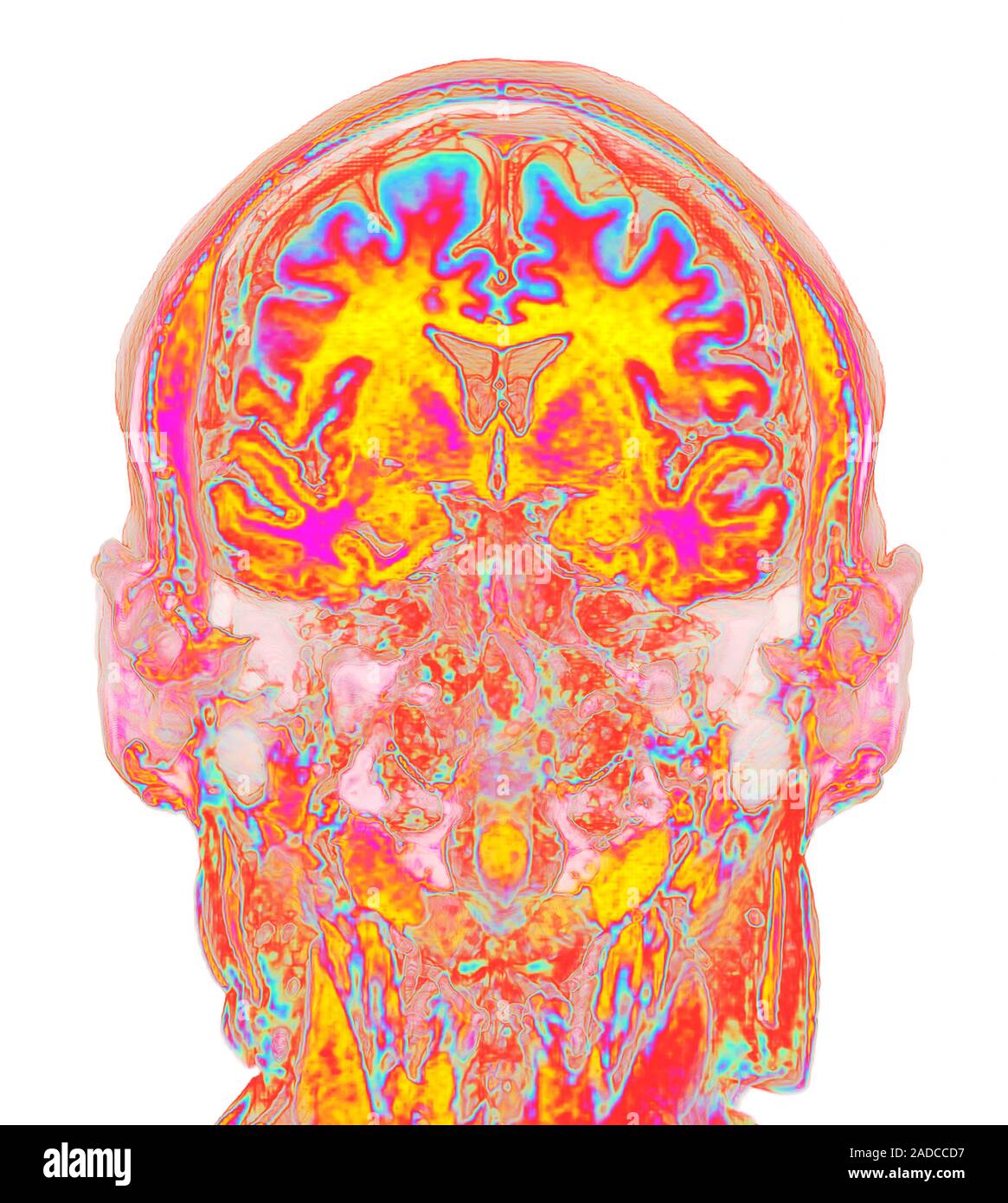 Menschlichen Kopf und Gehirn, farbige 3D-Magnetic Resonance Imaging ...