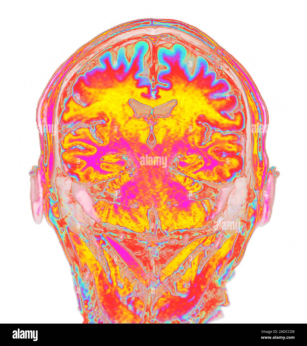 Menschlichen Kopf und Gehirn, farbige 3D-Magnetic Resonance Imaging ...