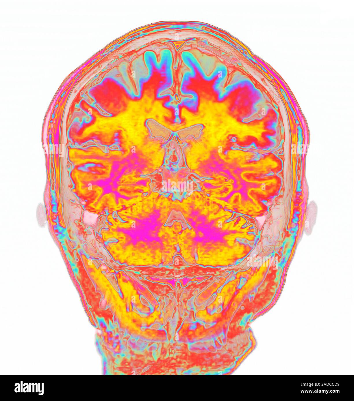 Menschlichen Kopf und Gehirn, farbige 3D-Magnetic Resonance Imaging ...