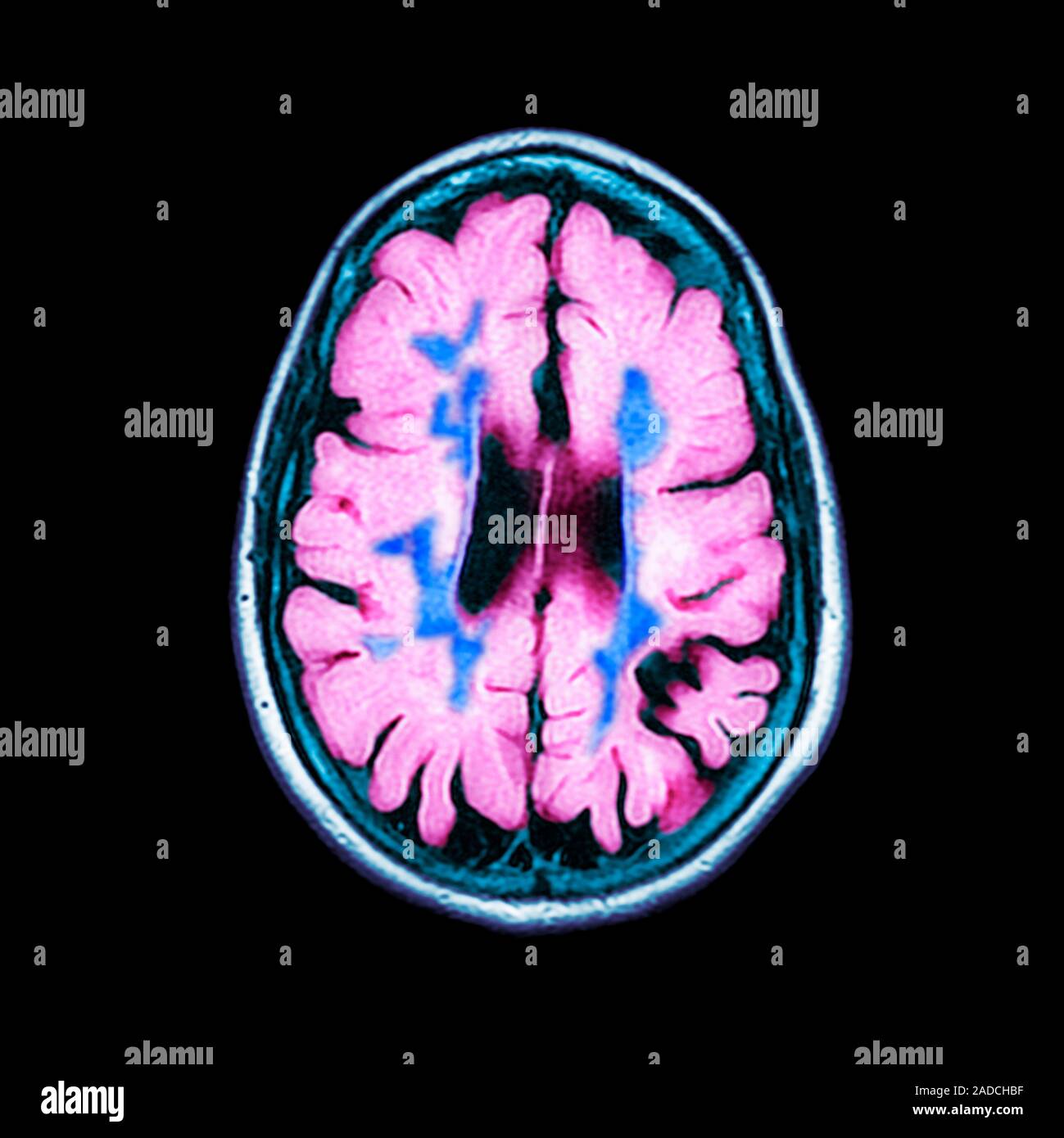 Multiple Sklerose. Farbige axial Magnetic Resonance Imaging (MRI) durch das Gehirn eines 53 ...