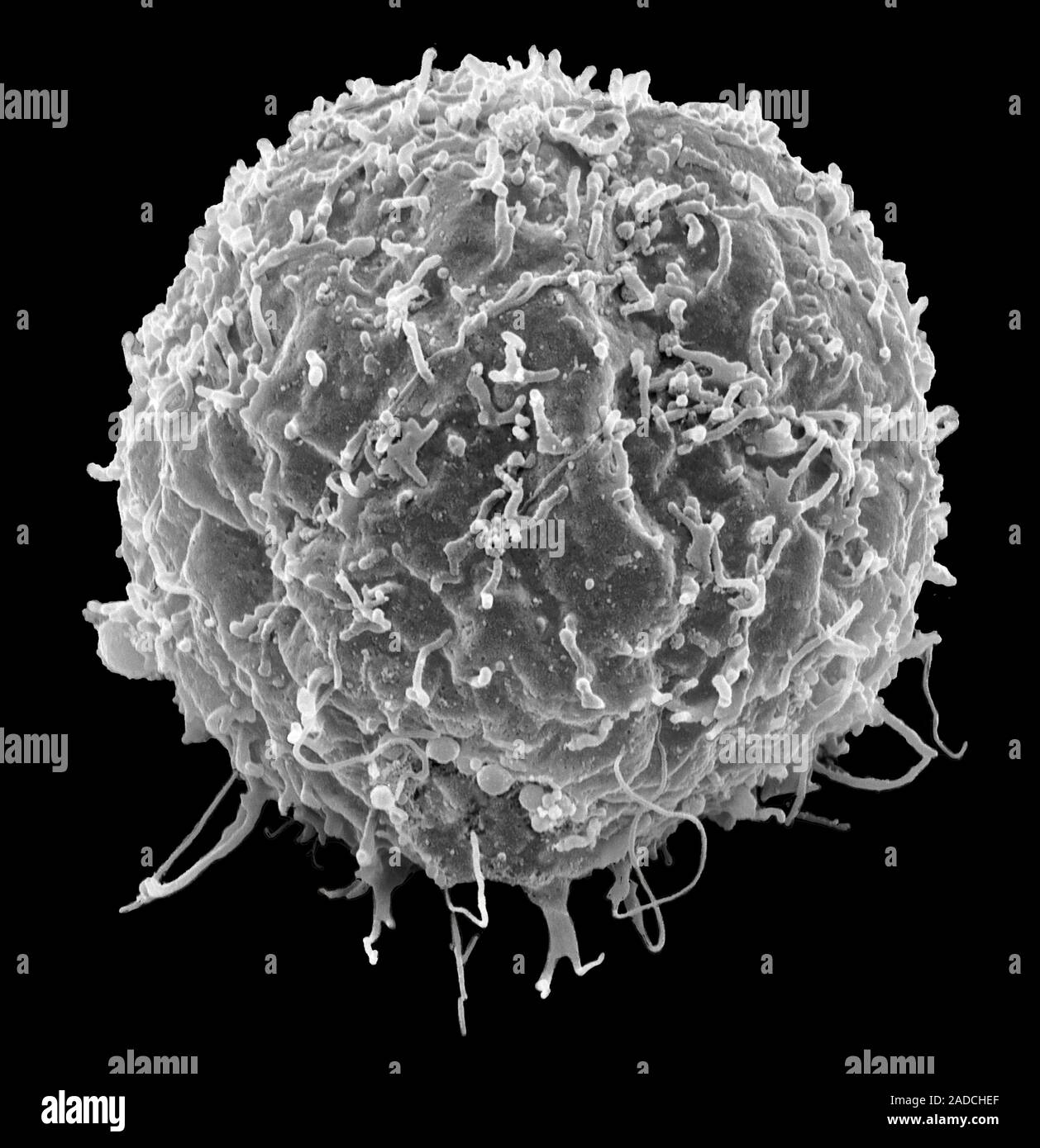 Gehirn Krebs Zelle. Scanning Electron Micrograph (SEM) von Krebszellen ...