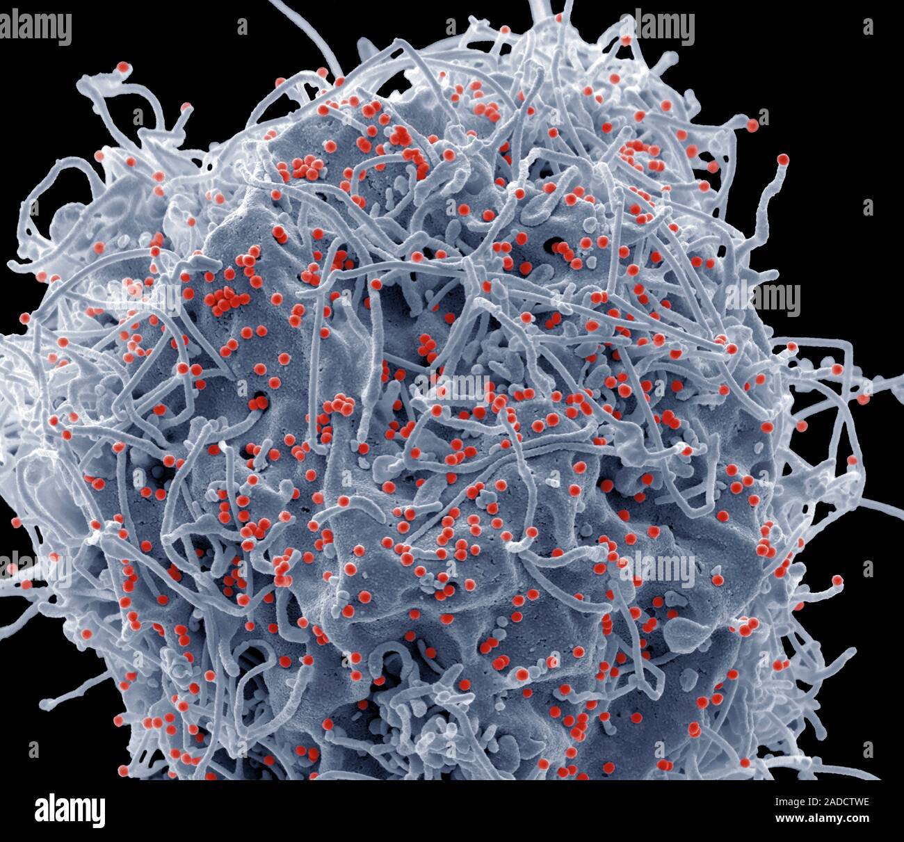 HIV-Infizierte 293 T-Zelle. Farbige Scanning Electron Micrograph (SEM ...