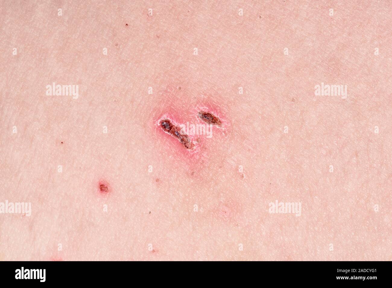 Pityriasis lichenoides chronica Läsionen an den Oberschenkel von einer ...