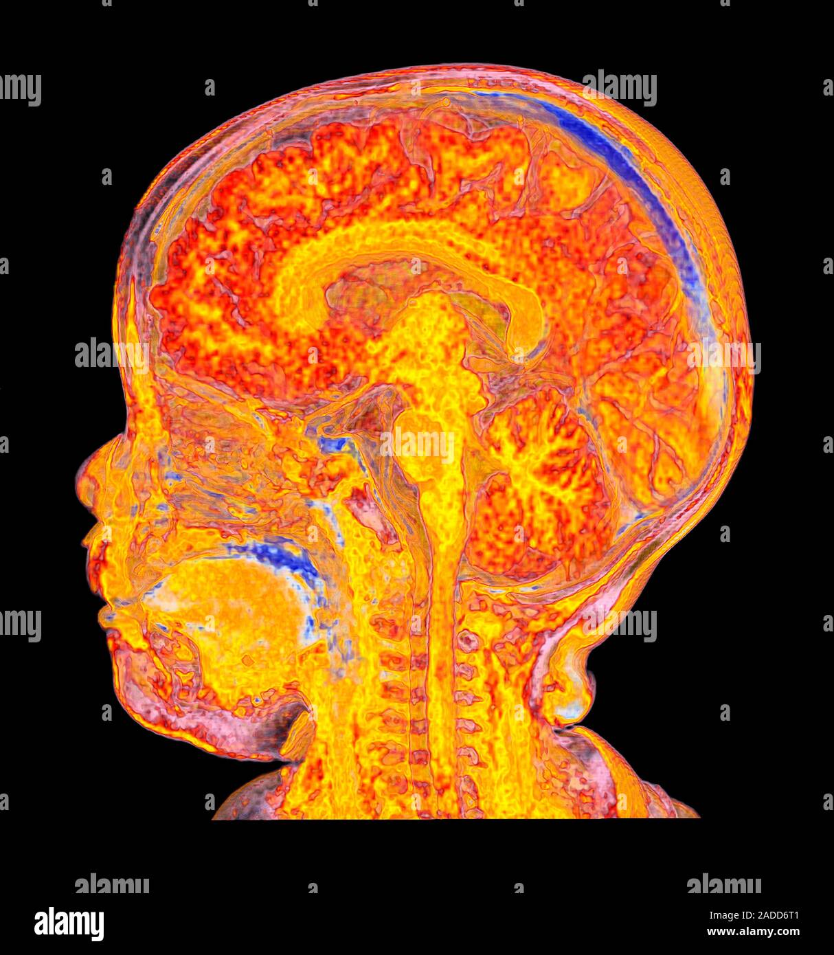 Child's Kopf und Gehirn. Farbige sagittale Magnetresonanztomographie (MRT) durch die Mittellinie ...