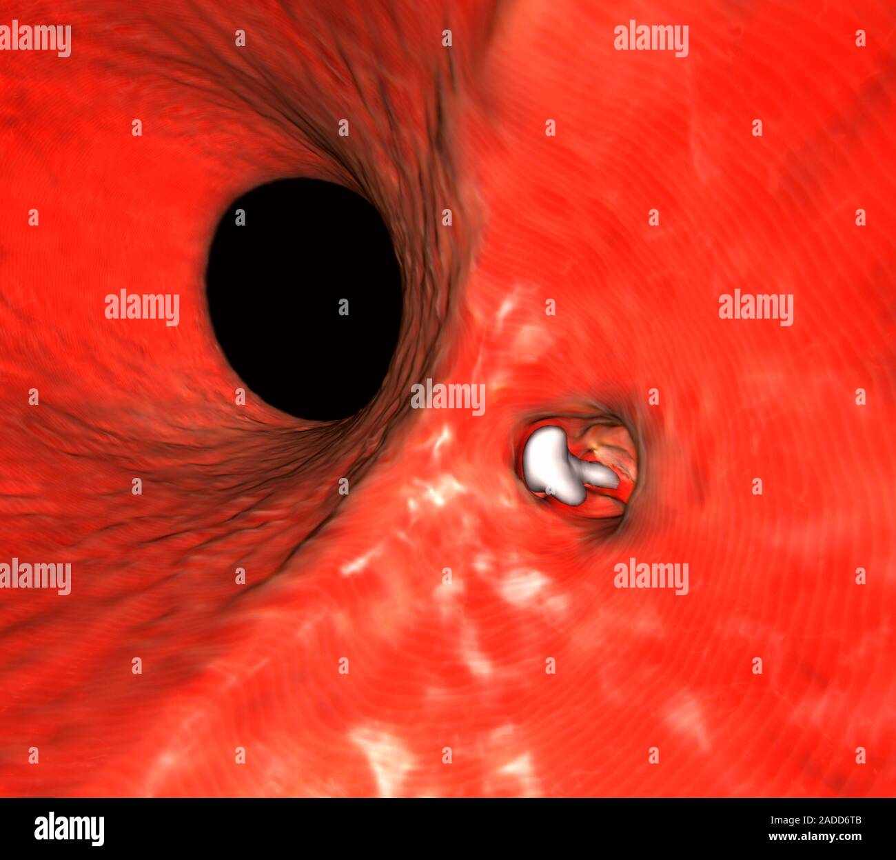 Koronare Herzkrankheit. 3D-Computertomographie (CT)-angiogramm der ...