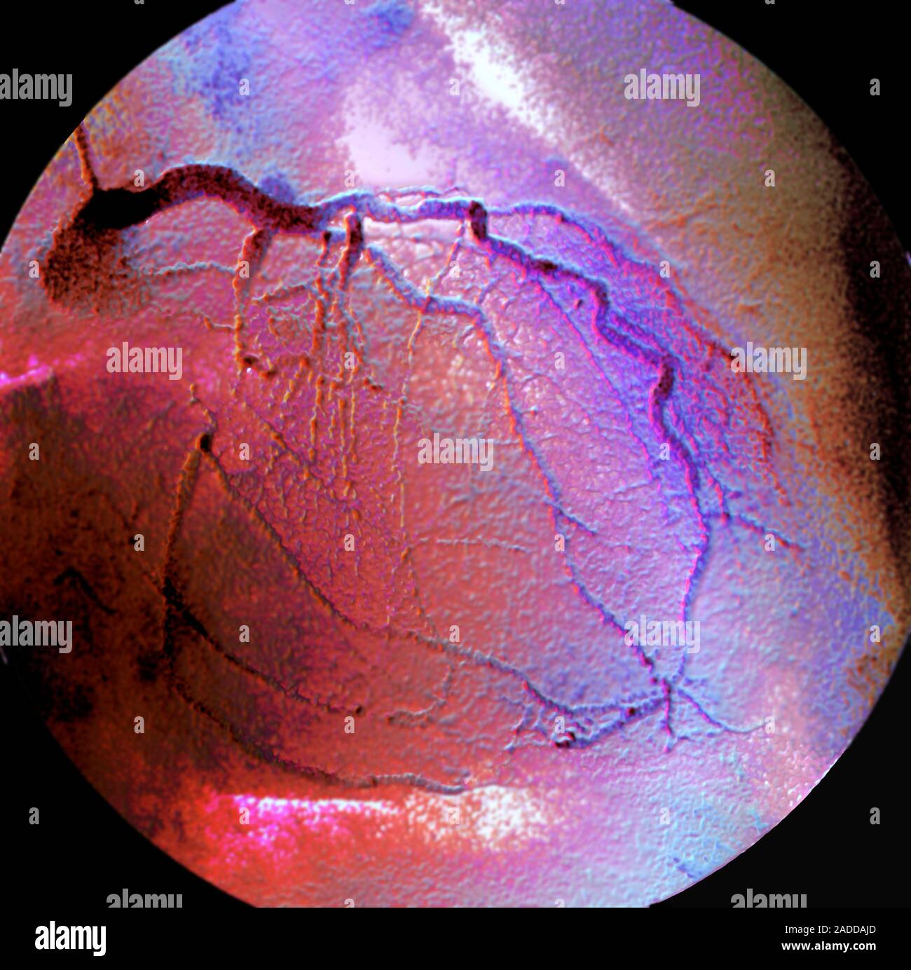 Koronare Stenose. Farbige coronarography (Kontrastmittel Röntgen) Scan ...