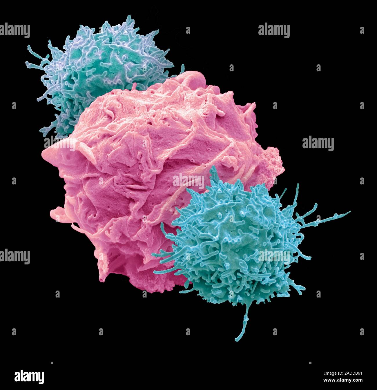 T-Zellen und Lymphome Krebs Zelle. Composite farbige Scanning Electron ...