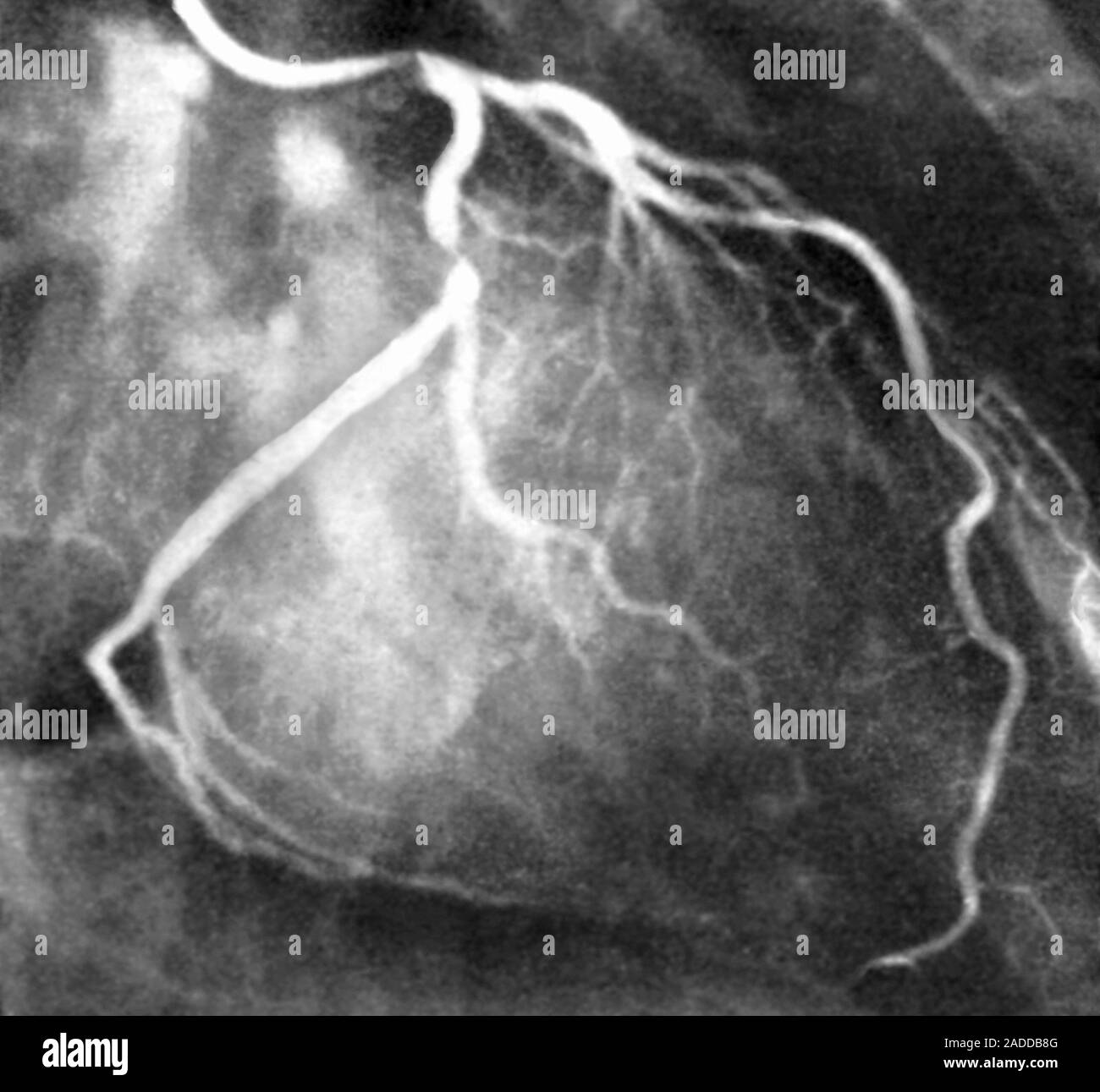 Koronare Stenose. Coronarography (Kontrastmittel Röntgen) Scan eines 59 ...