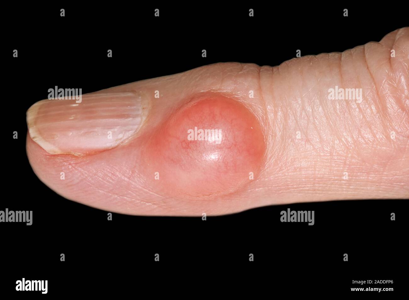 Synovialen Zyste am kleinen Finger von einem 82-jährigen Mann. Synovial ...