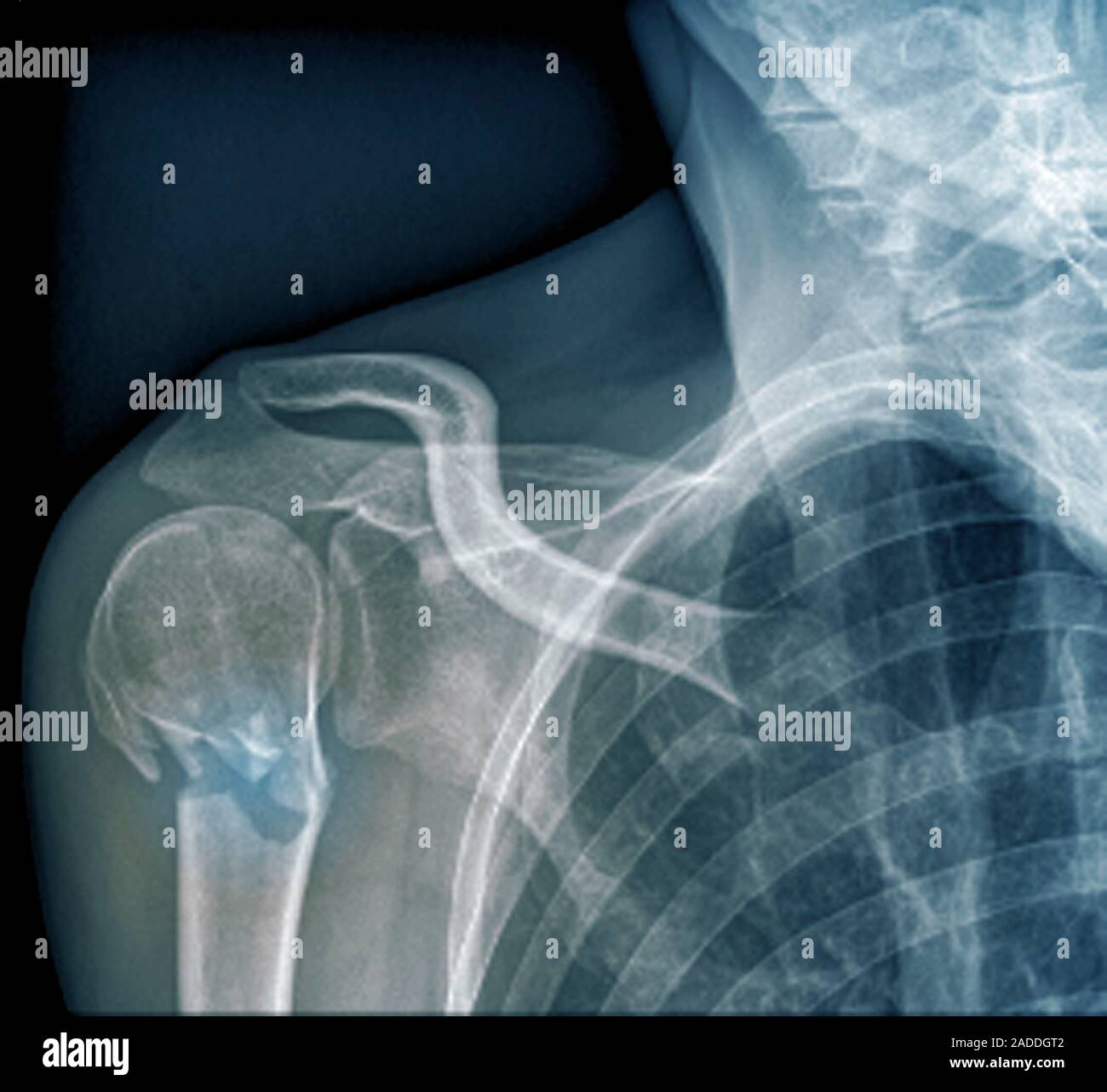 Gebrochenen Oberarmknochen. Farbige frontal X-ray von den gebrochenen ...