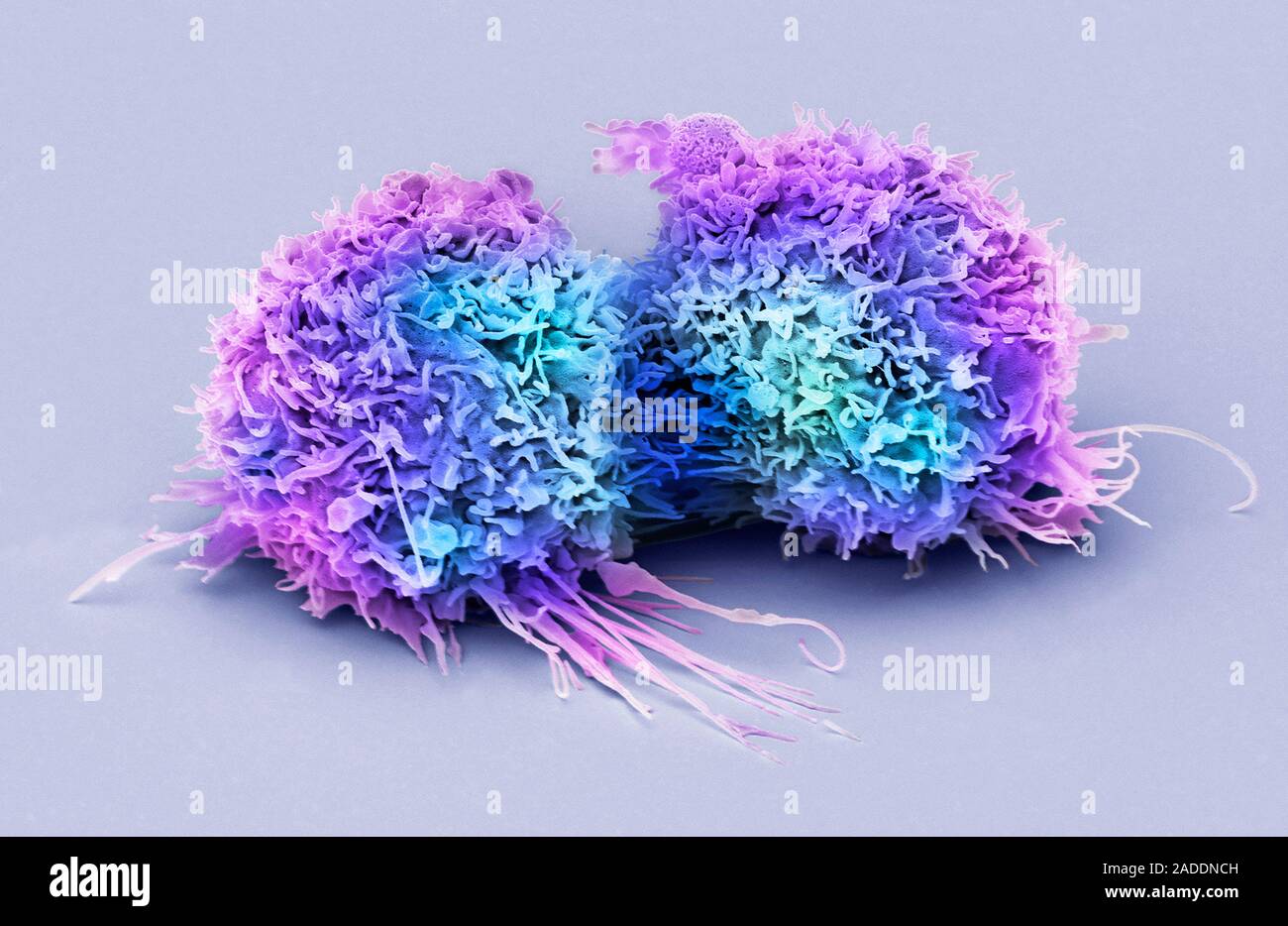 Lungenkrebs Zellen. Farbige Scanning Electron Micrograph (SEM) der ...