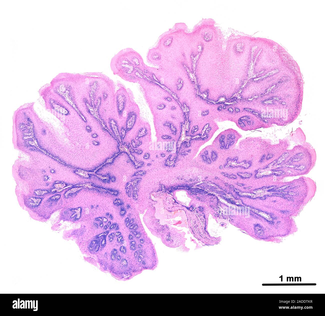 Weichen Gaumen Papilloma, Licht schliffbild. Ein Papilloma ist ein ...