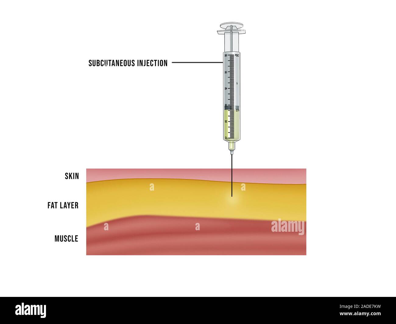 Die subkutane Injektion, Illustration. Diese Art der Injektion ...