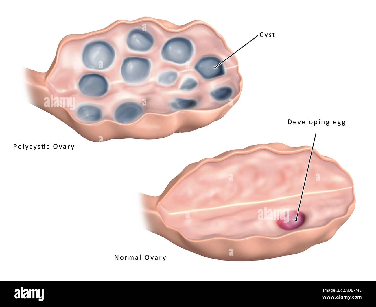 Einem polyzystischen Ovarialsyndrom im Vergleich zu einem normalen Ovar ...