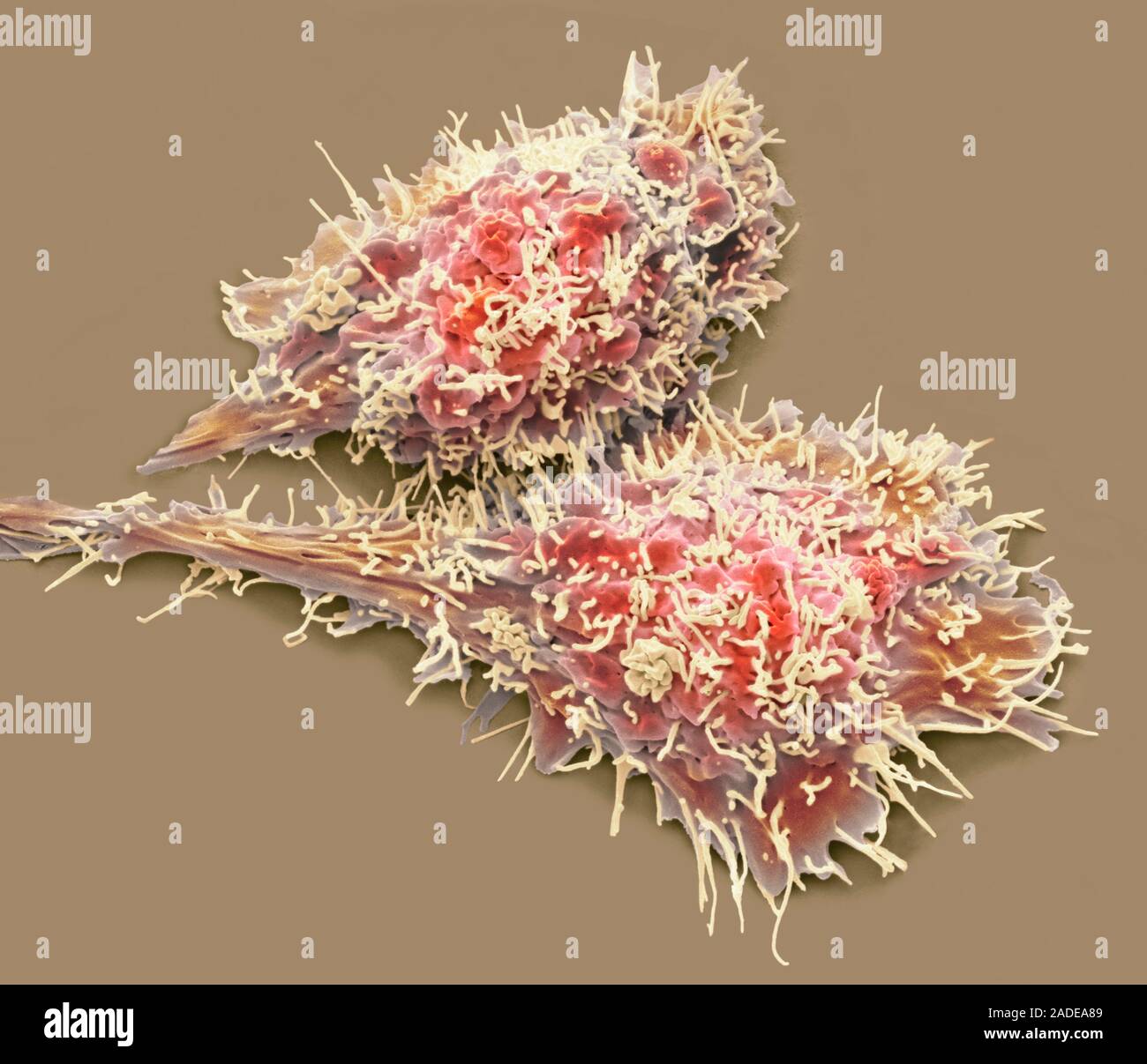 Leberkrebs Zellen. Farbige Scanning Electron Micrograph (SEM) von ...