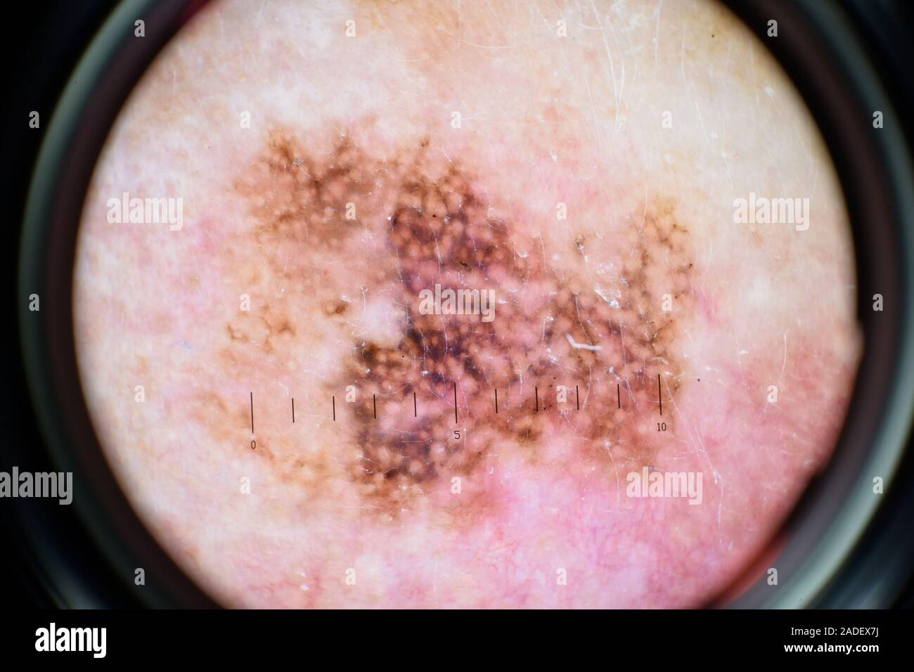 MODEL RELEASED. Lentigo maligna Melanom auf der Haut einer 90-jährigen ...