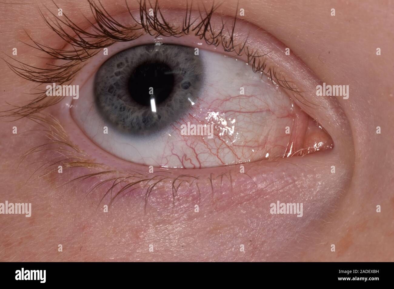 MODEL RELEASED. Episkleritis. Close-up auf dem rechten Auge eines 9 ...