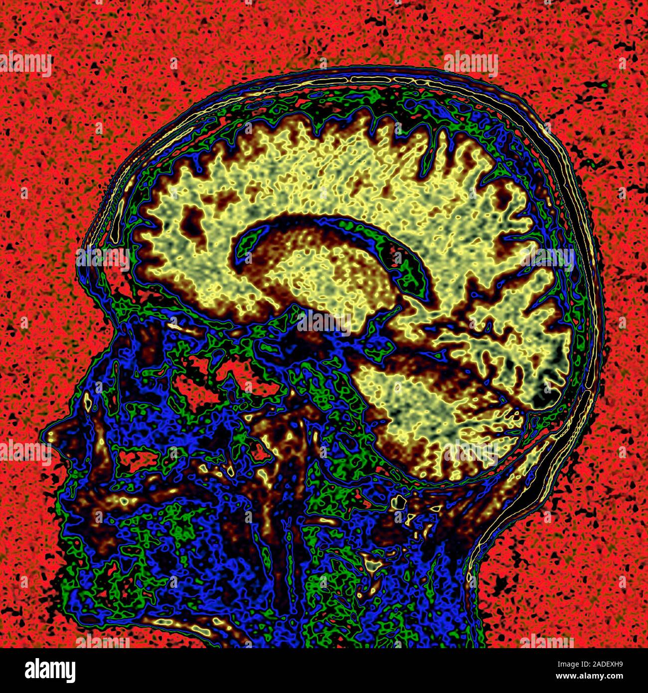 Menschlichen Kopf und Gehirn. Farbige sagittale Magnetresonanztomographie (MRT) Scan eines ...