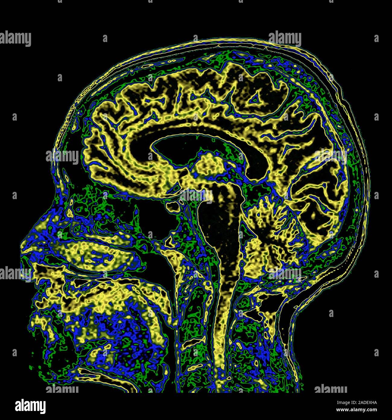 Menschlichen Kopf und Gehirn. Farbige sagittale Magnetresonanztomographie (MRT) Scan eines ...