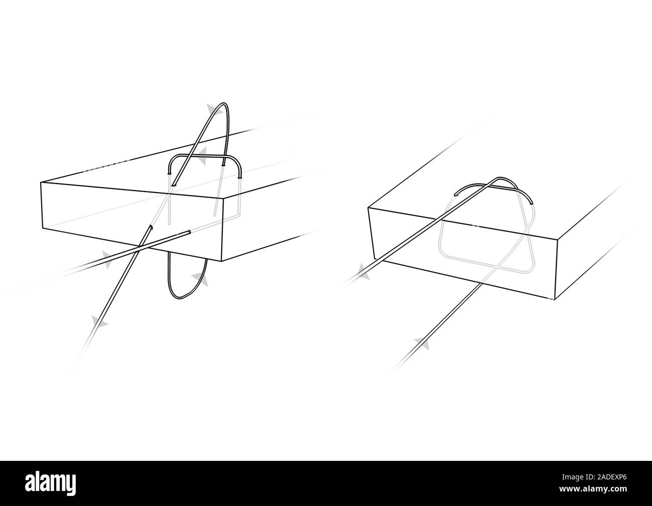 Mason-Allen Naht in der schulterchirurgie, Illustration. Die Mason ...