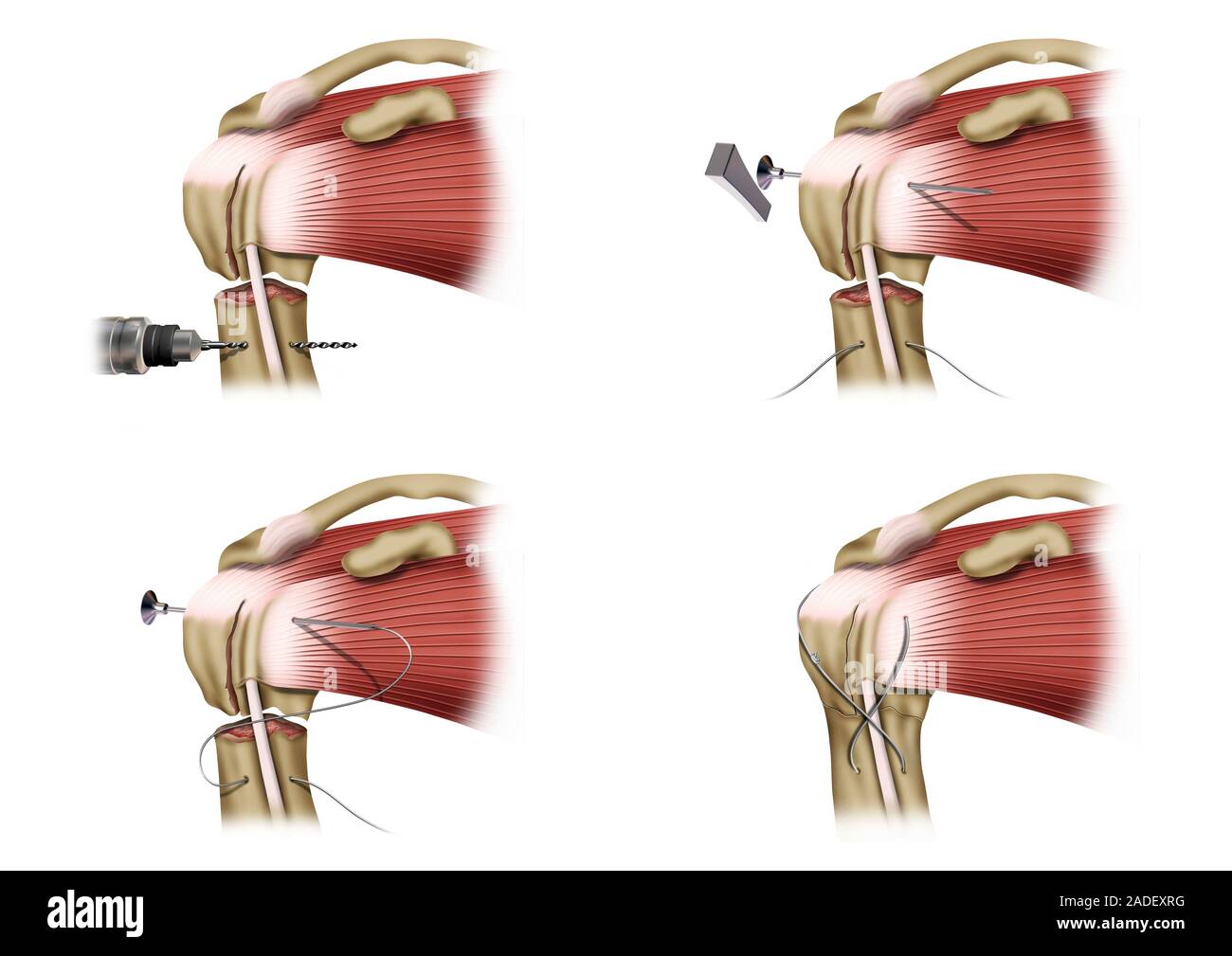 Cerclage Verkabelung in Schulter Bruch Chirurgie, Illustration. Bohren ...