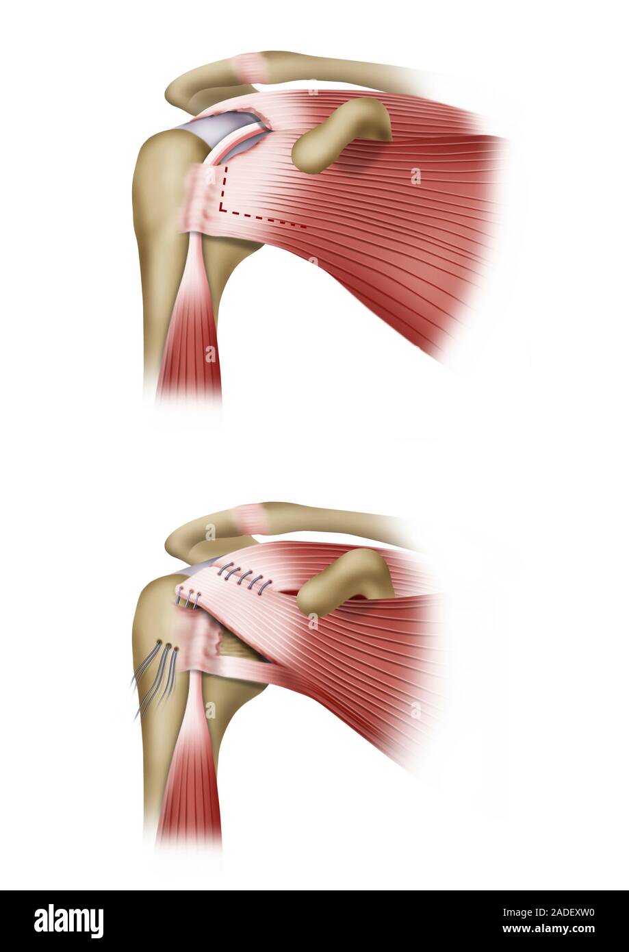 Schultermuskulatur Chirurgie, Illustration. Die Muskeln werden hier ...
