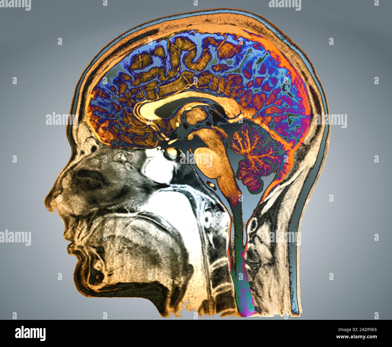 Menschlichen Kopf und Gehirn. Farbige Magnetresonanztomographie (MRT) Scan eines sagittale ...