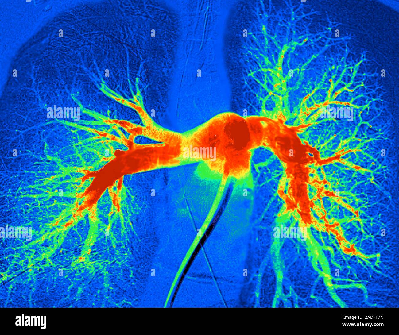 Die Blutgefäße der Lunge, farbige Angiogramm (Blutgefäß X-ray). Die ...