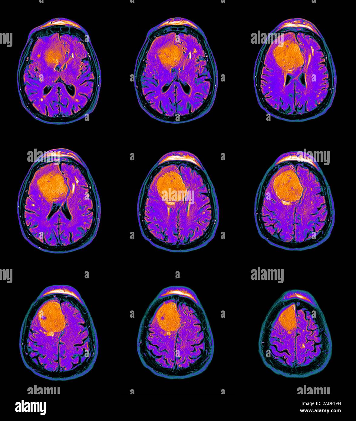Meningeom Hirntumor. Farbige axial Magnetic Resonance Imaging (MRI ...