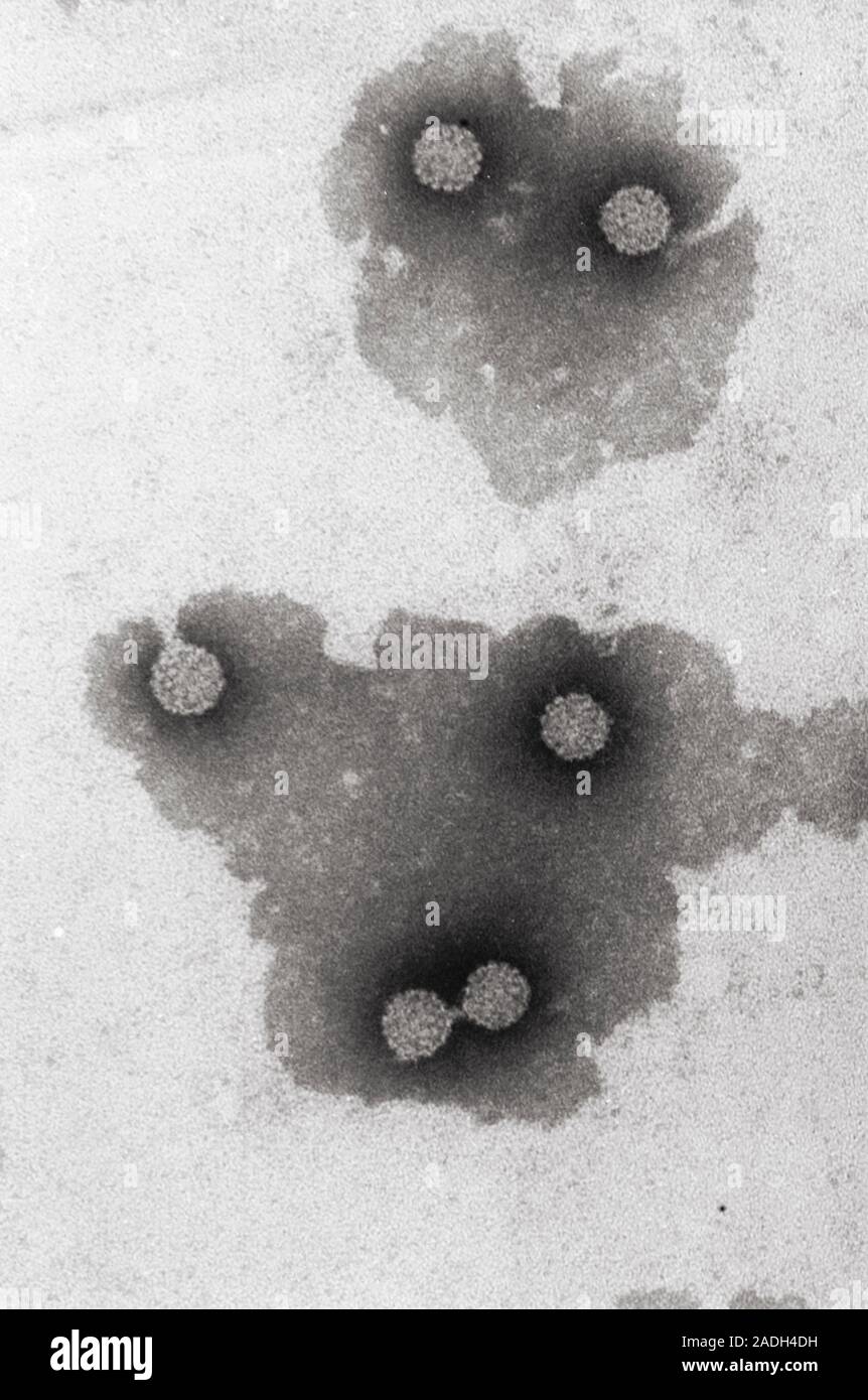 Transmission Electron Micrograph von plantar Warze Virus, die Ursache ...