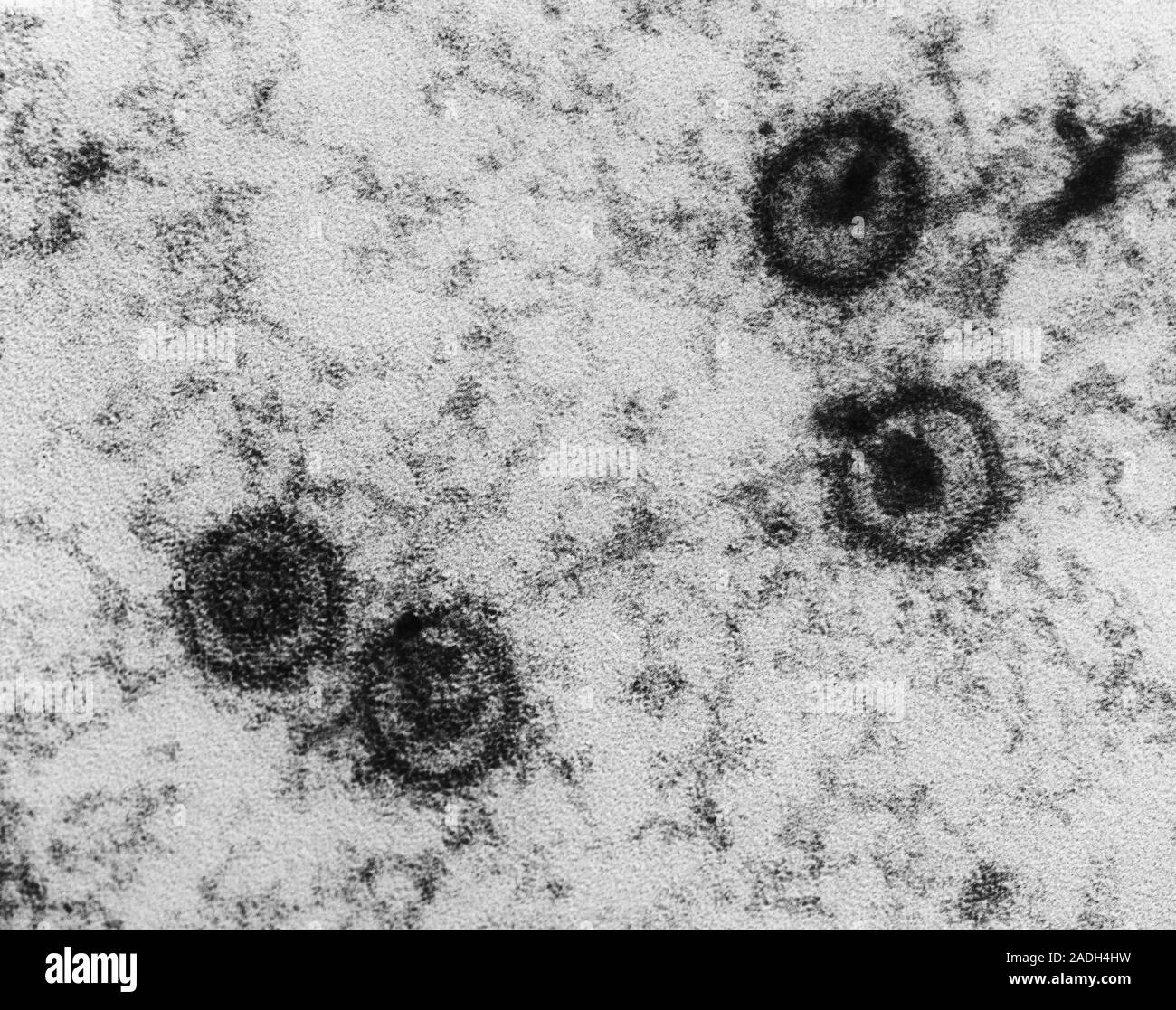Epstein-Barr-Virus, EBV. Transmission Electron Micrograph von Epstein ...