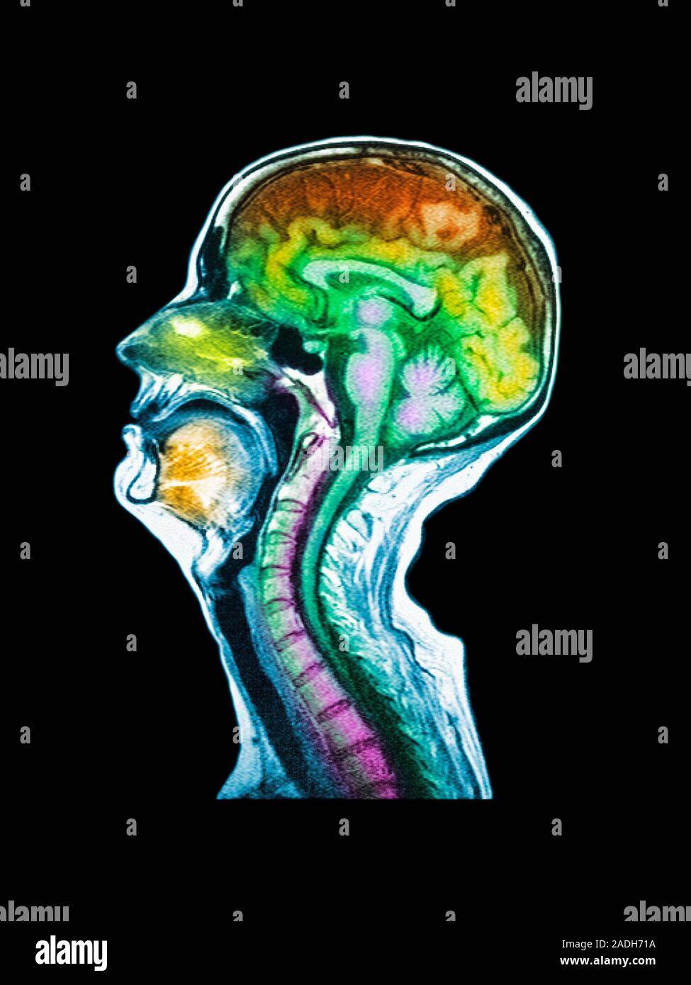 Gehirnatrophie. Farbige Magnetresonanztomographie (MRT) Scan eines Sagittalschnitt durch das ...
