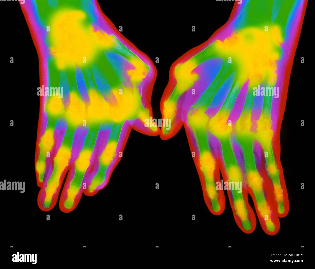 Arthritic Hände. Farbige computer-Enhanced X-ray der Hände leiden ...